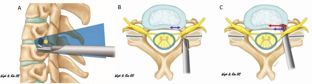 Endoscopic Spine Surgery in Singapore - Achieve Spine