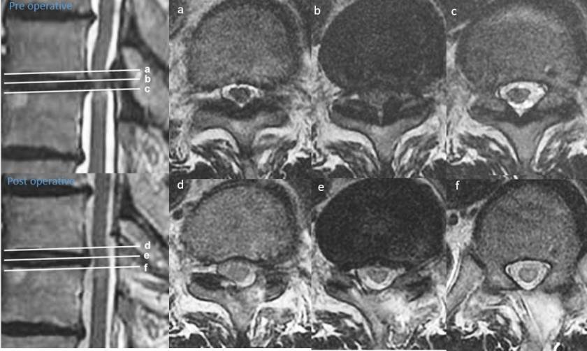 Endoscopic Spine Surgery in Singapore - Achieve Spine