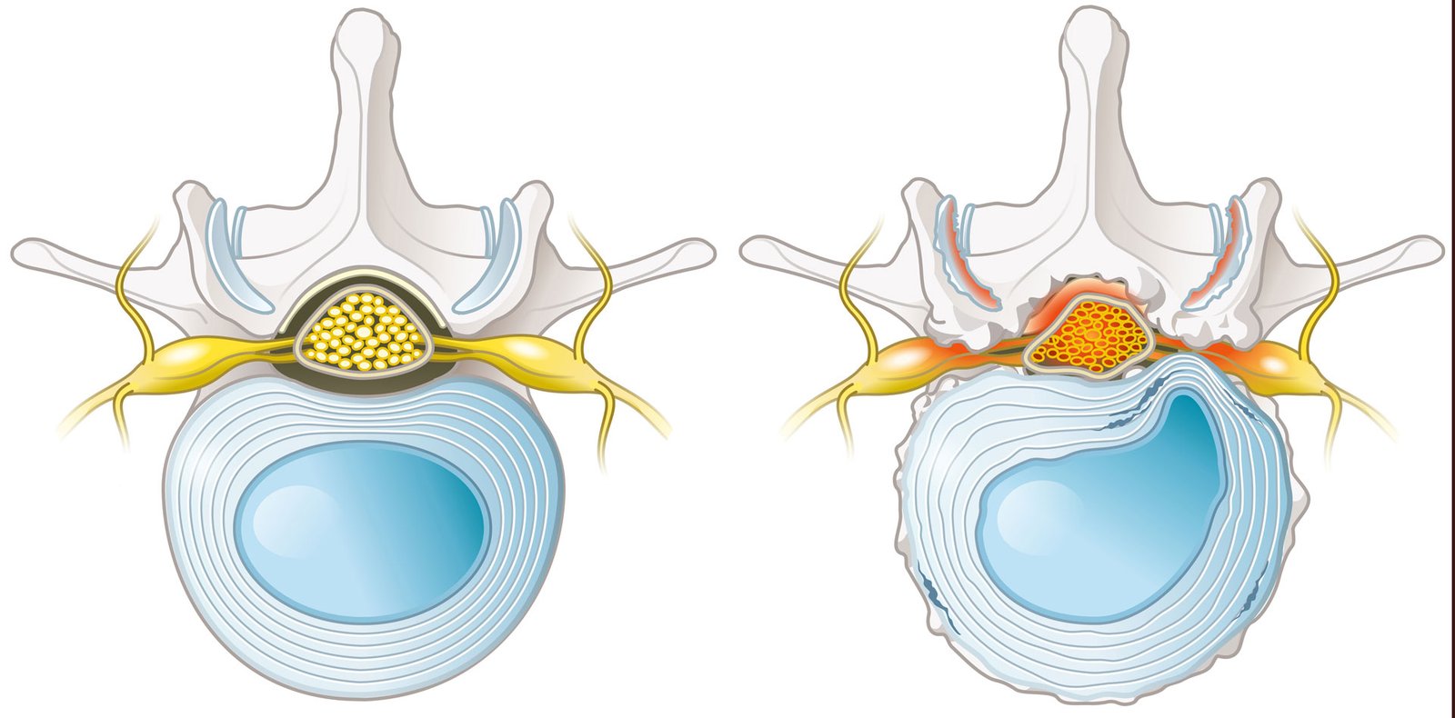 Spinal Stenosis Surgery & Treatment | Achieve Spine
