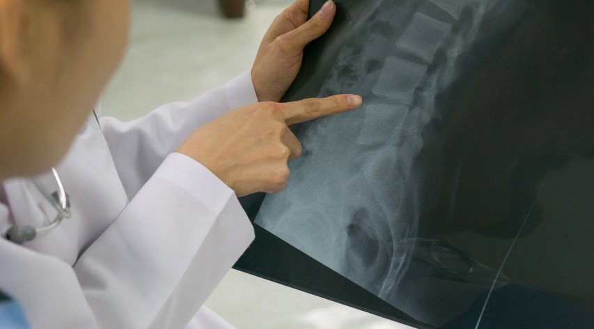 Radiculopathy Treatment - Achieve Spine And Orthopaedic Centre